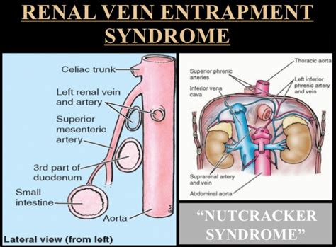Nutcracker Syndrome Vs Phenomenon At Alex Cruz Blog