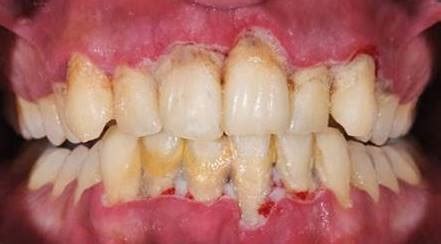 Enfermedad De Las EncÍas Clinica Dental Erica Franco