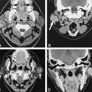Pleomorphic Adenoma Parotid Ct