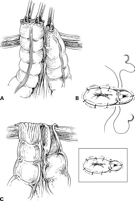 Mucous Fistula