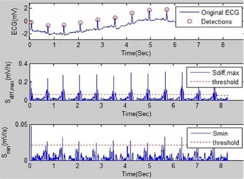 Figure 1 From A Computationally Efficient Qrs Detection Algorithm For