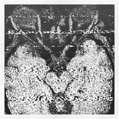 Mri Zipper Artifact Someone Left The Scanner