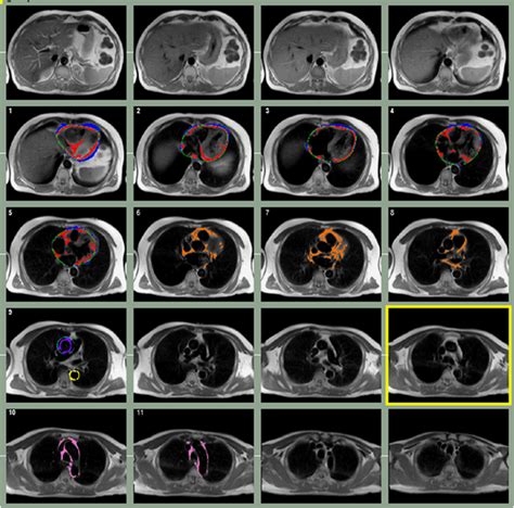 Segmentation Of Epicardial Fat Red Paracardial Fat Blue Download Scientific Diagram