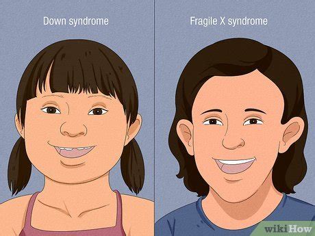 Fragiles X Syndrom Fragile X Syndrome Neurology Medbullets Step