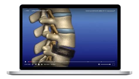 Lumbar Lateral Lumbar Interbody Fusion Llif Animation