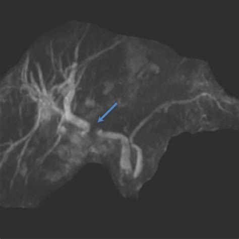 Control ERCP After Months Of The Procedure Adequate Anastomosis Download Scientific Diagram