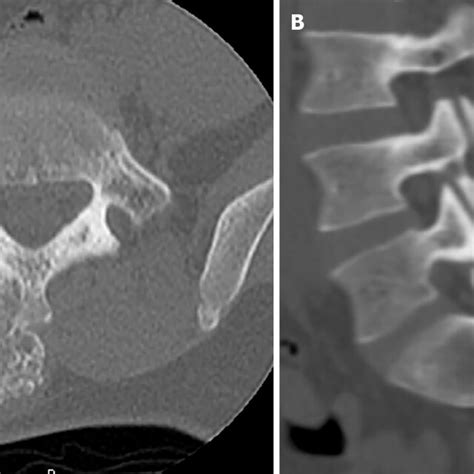 Computed Tomography Imagines A Axial Computed Tomography Imaging