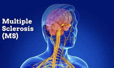 【补充剂方】 多发性硬化症 安疗生活