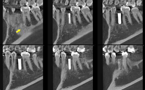 Full Text Dental Implant Placement In Focal Osteoporotic Bone Marrow