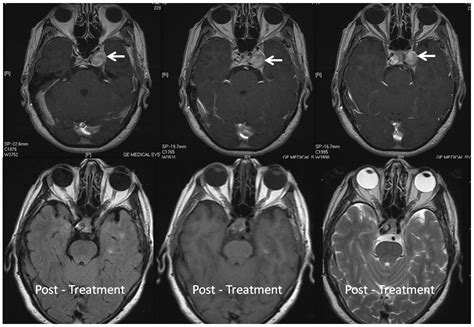 Pipeline Device Aneurysm Selection