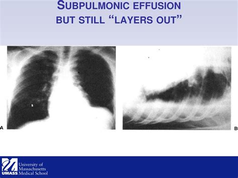 Ppt Management Of Pleural Effusions Hueh 2011 Terry Flotte Md