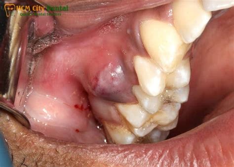 Infection After Tooth Extraction 5 Key Signs And Solutions Dr Cuong