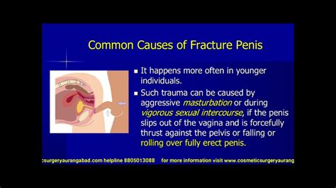Penis Fracture Reconstructive Plastic Surgery Repair With Good Erectile Function Cosmetic