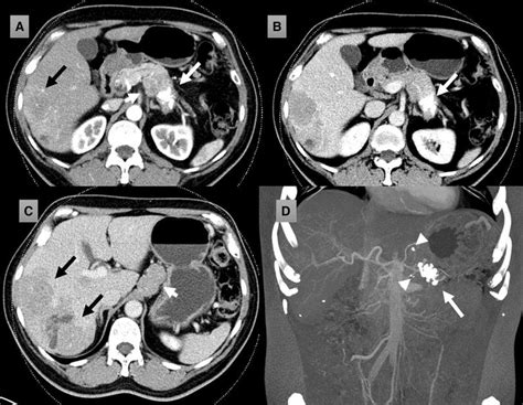 58 Year Old Man With Pancreatic Mass Iv Contrast Enhanced Ct In Axial