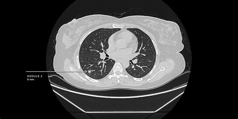 Validation Of A Cad System For Lung Nodule Analysis Reliable Detection