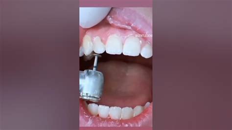 Enameloplasty Technique🦷 Youtube