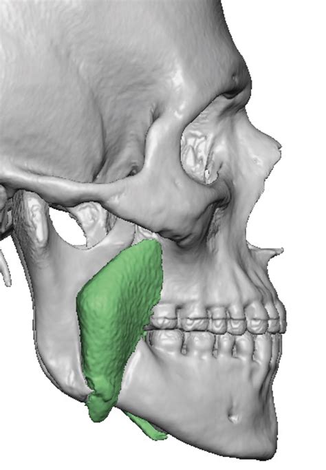 Plastic Surgery Case Study Custom Jaw Angle Implant Replacements For Severely Malpositioned