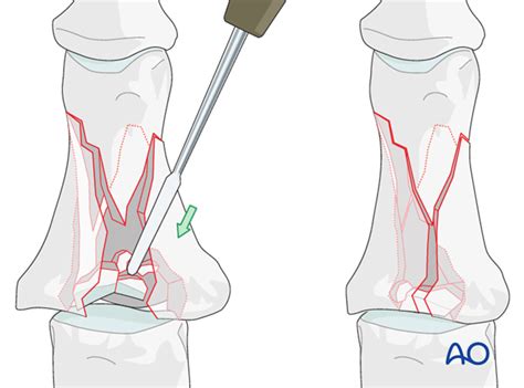 Open Reduction Internal Fixation Orif For Proximal Phalanx Base And