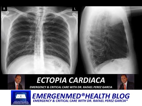 Emergenmed Health Blog Ectopia Cardiaca Abdominal