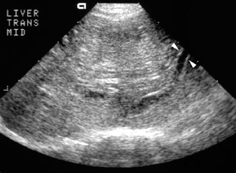 Sonographic Image Of The Liver And Common Bile Duct Note The Dilated