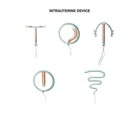 IUD Bleeding After Sex 3 Most Important Reasons