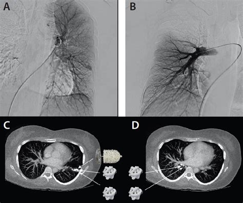 Smart Polymer Embolization Plus Endovascular Today