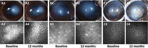 No Significant Differences In Endothelial Cell Density Ecd Or Extent Download Scientific