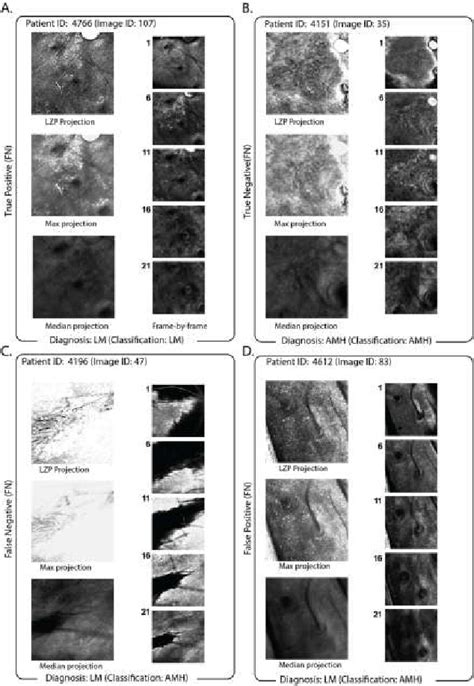 Comparison Of Lzp Projection Vs Max And Median Projection For