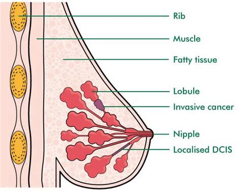 What Is The Difference Between Dcis And Invasive Ductal Carcinoma