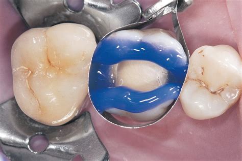 Dental Adhesive Bonding Etching How Its Made