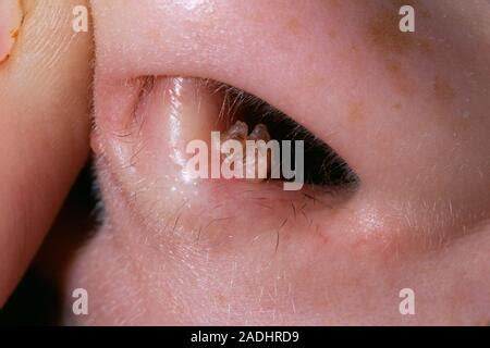 Nasal Warts Fibrous Papules Or A Clear Bump On The Tip Of The Nose