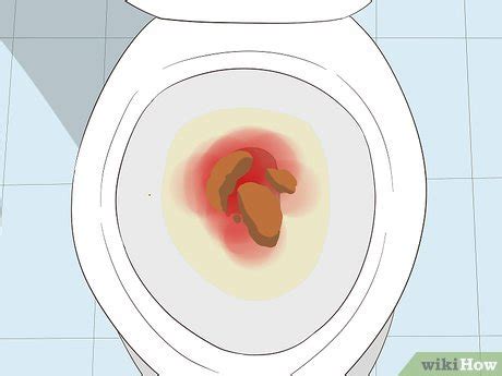 Color Of Stool With Colon Cancer