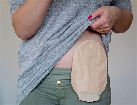 Colostomy What Is It And How Is The Procedure Done