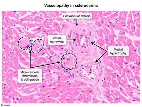 Scleroderma And Crest Syndrome Rheumatology And Orthopedics Uworld Medical Library