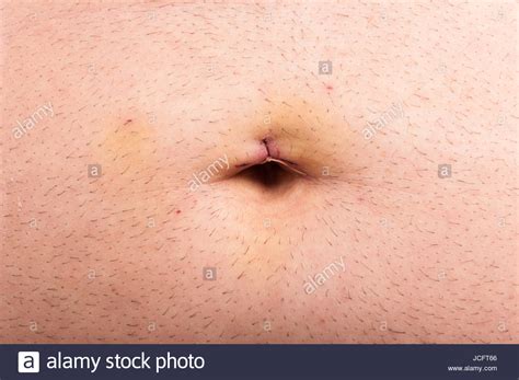 Closeup Of Belly Stitch After Laparoscopic Surgery Of Gallbladder