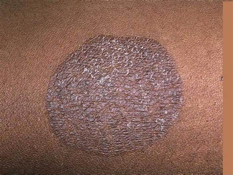 El RincÓn De La Medicina Interna Juanpedromacaluso Ar Eritrasma A PropÓsito De Un Caso