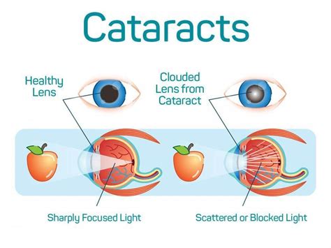 Cataracts Causes Symptoms Natural Support Strategies Artofit