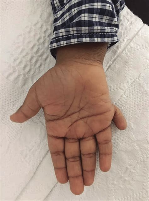 Unilateral Ulnar Polydactyly Download Scientific Diagram