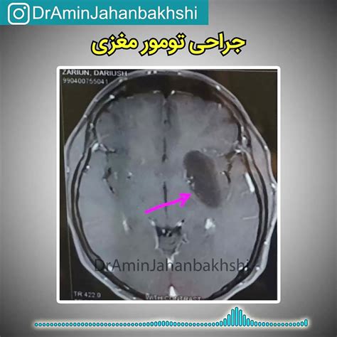 جراحی تومور مغزی دکتر امین جهان بخشی