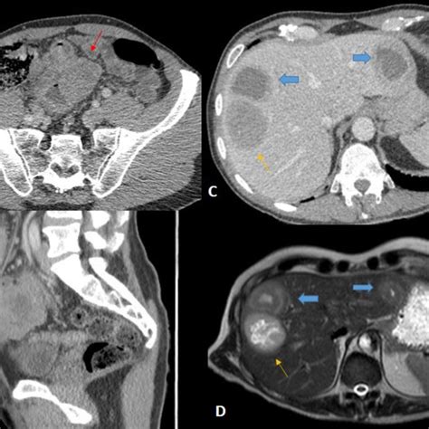 A Coronal And B Axial Enhanced Ct Showing A Small Bowel Gist Red