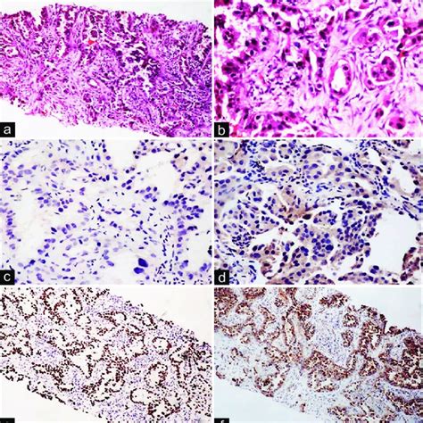 A And B Adenocarcinoma Showing Predominantly Lepidic Pattern With Download Scientific Diagram