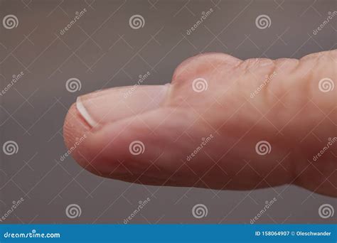 Small Round Or Oval Bumps On A Finger Near A Nail In Latin Myxoid Cyst Also Called A Digital