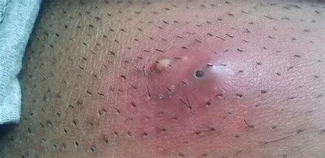 Ingrown Hair Cyst In Pubic Area