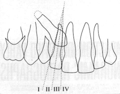 Evaluation Of A Correlation Between The Severity Of Root Resorption Of Adjacent Teeth And Level