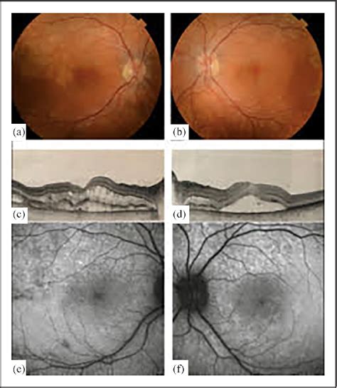 Figure 1 From Hypertensive Choroidopathy In Atypical Hemolytic Uremic