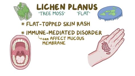Lichen Planus Video Anatomy Definition And Function Osmosis