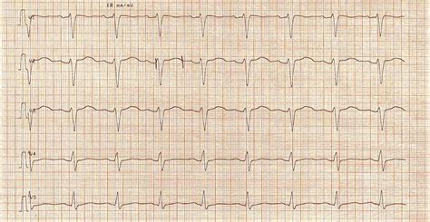 Hypocalcemia Ekg Prolonged Qt