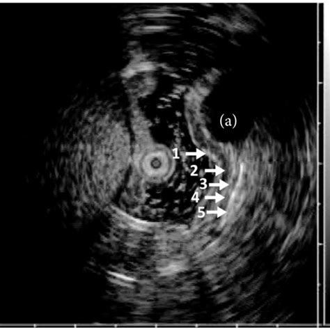 Pdf Endoscopic Ultrasound Fine Needle Aspiration Versus Core Biopsy