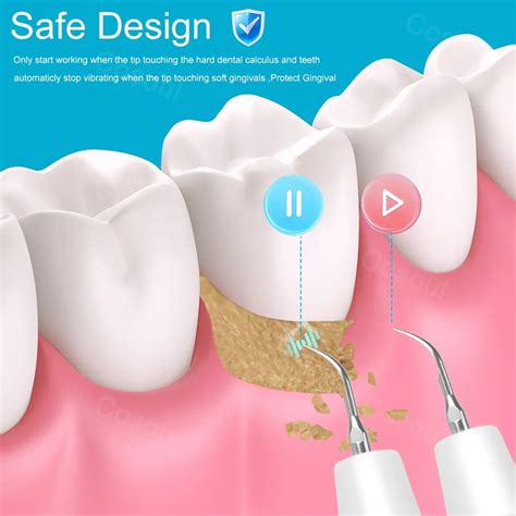 Ултразвуков апарат за премахване на зъбен камък Ефикасно и безопасно почистване на зъбите у
