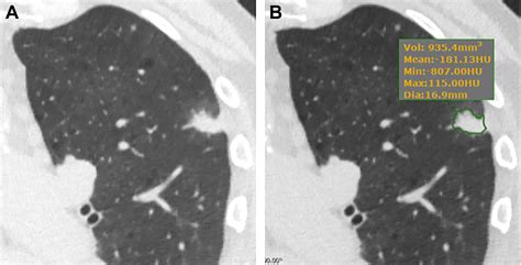 Imaging Of Solid Pulmonary Nodules Clinics In Chest Medicine
